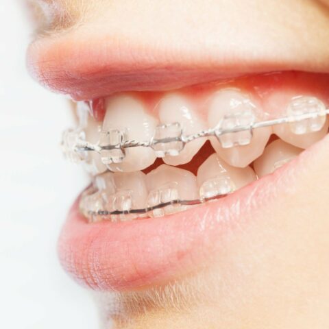 Brackets estéticos en Sevilla | Clínica dental Fos